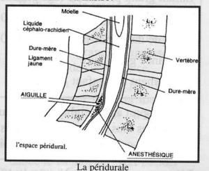 PERIDURALE A LA MATERNITÉ - LE BLOC ANESTHESIE