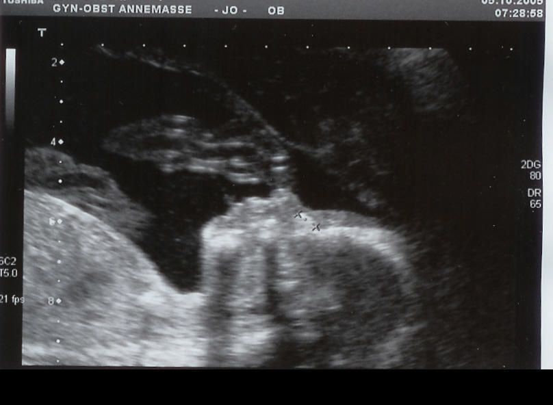 Echographie morphologique: attention si vous ne voulez pas savoir le ...