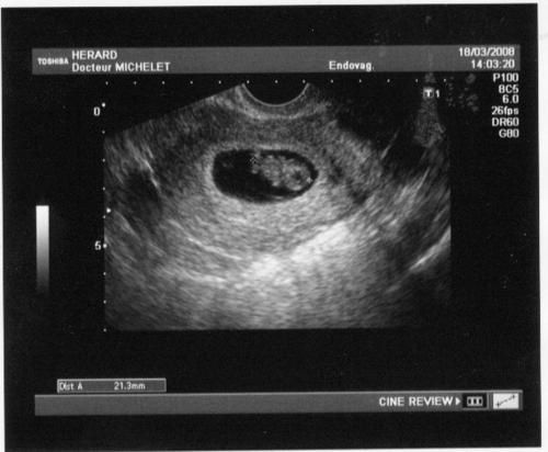 premiere échographie : 8 semaines de grossesse - le blog moiviolette