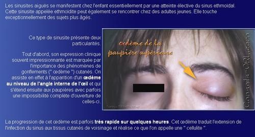 Une maladie à [RE]connaître rapidement ! - le blog des adhérents fcpe ...