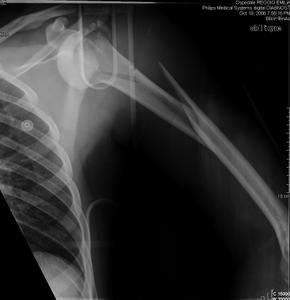 Frattura bifocale (pluriframmentaria) dell'omero con frattura del ...