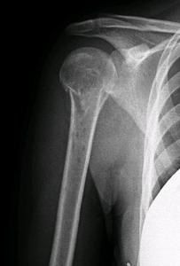 Frattura scomposta dell' omero prossimale - Chirurgia Ortopedica Funzionale