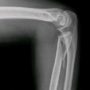 Frattura scomposta del capitello radiale e della diafisi del radio ...