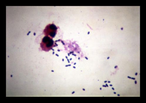 Liquide céphalo-rachidien - Examens directs ou portraits des bactéries