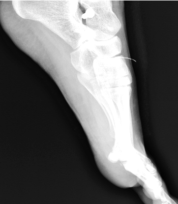 Calcaneo stop in una ragazza di quasi 16 anni - Ortopedia