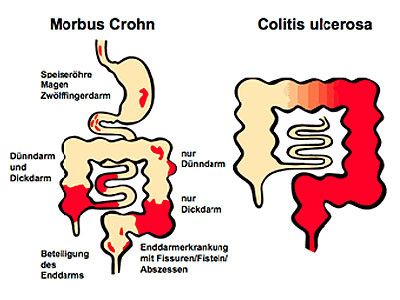 Crohn /RCUH - Le blog de prof75