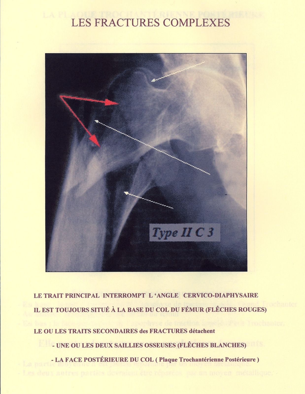 LES FRACTURES COMPLEXES - Le blog de Yves Cirotteau