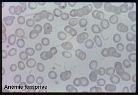 Bilans d'hématologie - taysir assistance
